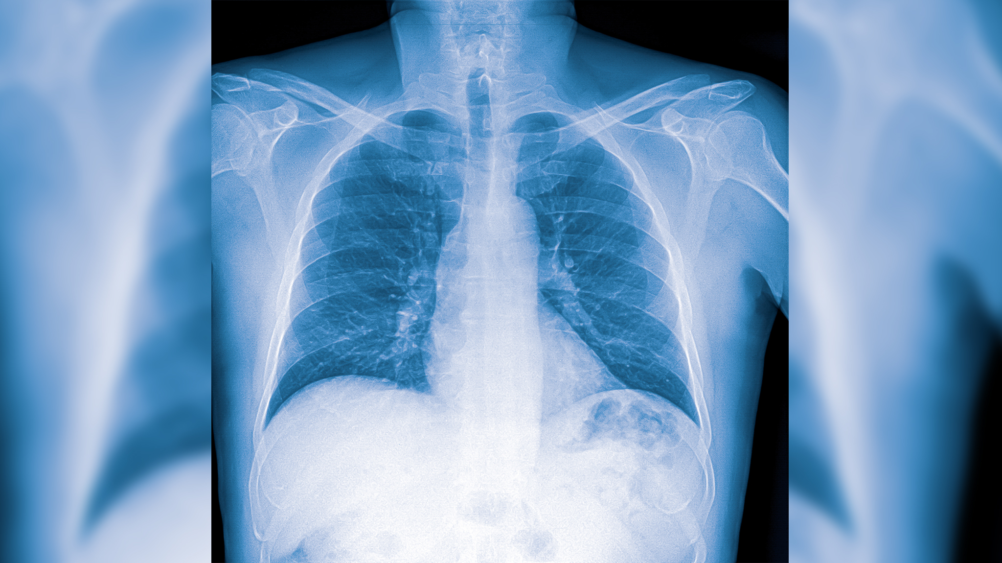 Deep Breaths: Updates from CHEST - Global Cardiology Academy